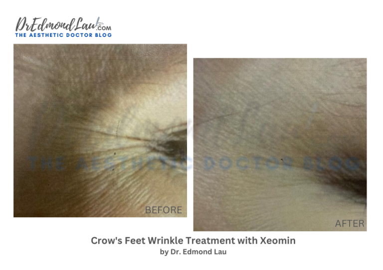 Xeomin - All you need to know about it - Dr Edmond Lau .COM Blog